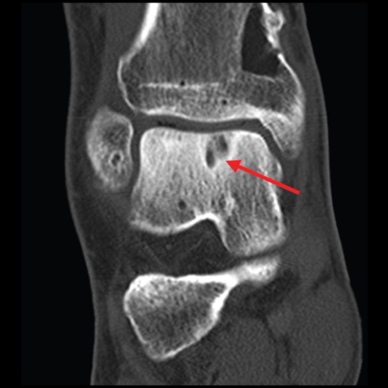 How to treat a osteochondral lesion of the talus - Dr Stefan Wever