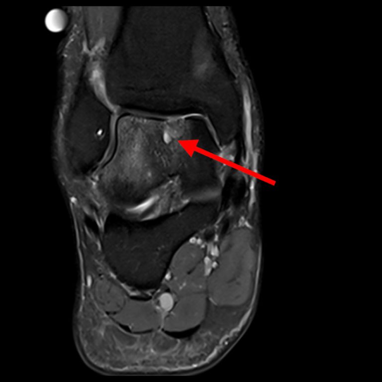 How to treat a osteochondral lesion of the talus - Dr Stefan Wever