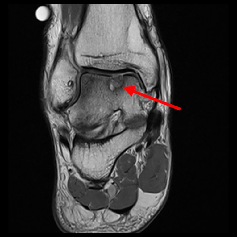 How to treat a osteochondral lesion of the talus - Dr Stefan Wever