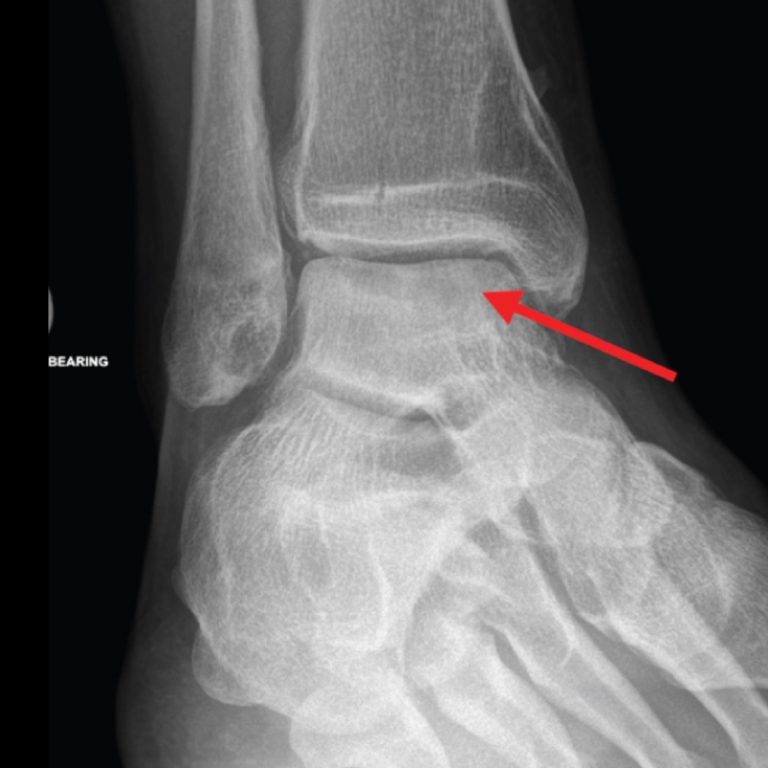 How to treat a osteochondral lesion of the talus - Dr Stefan Wever